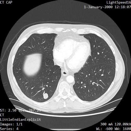 LungNodule UNET Semantic Segmentation Dataset And Pre Trained Model By Lung Nodule