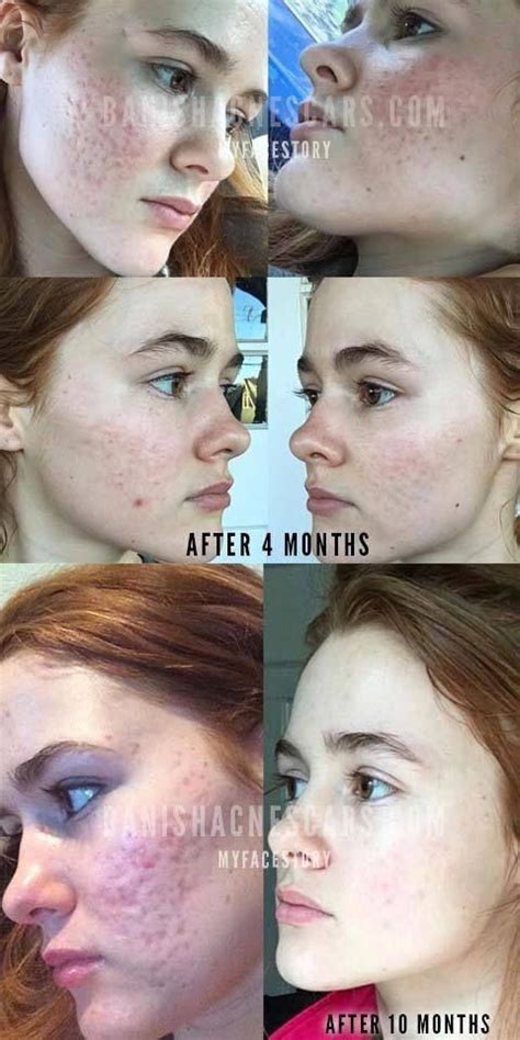 Types Of Bumps And Blemishes You Should Never Try To Pop Natural Skin Care Routine Natural