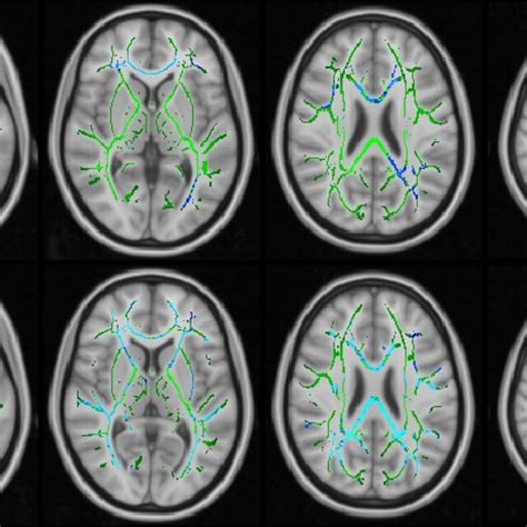 Hypothetical Framework Of Pathological Events Leading To Structural And Download Scientific