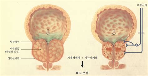 전립선질환