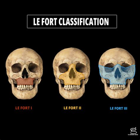 Fraturas Do Crânio Diferença Entre As Fraturas De Lefort I Ii E Iii