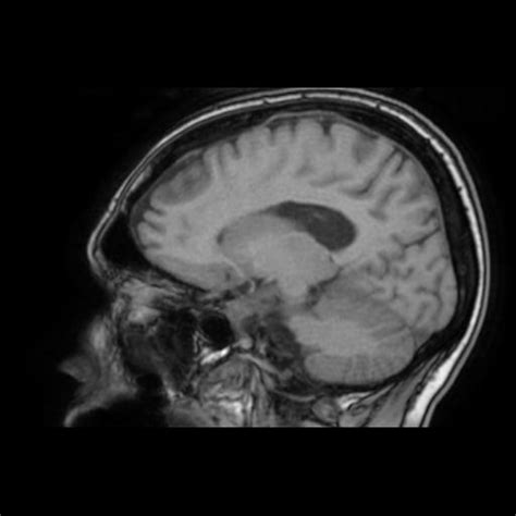 Radiopaedia Case Choroid Plexus Xanthogranulomas Id Study NC Commons