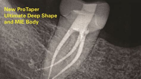 Deep Shape In Endodontics Significance Rationale And Benefit Oral Health Group