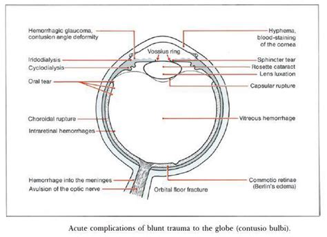 Complications Of Ocular Ophthalmology Notes And Synopses