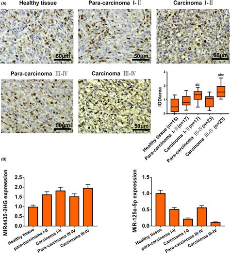 Taz Expression Was High In The Brain Tissue Of Glioma Patients And It