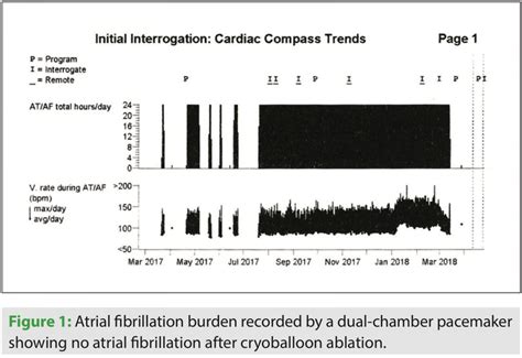 Cryoballoon Ablation As A Second Procedure For Persistent Atrial Fibrillation