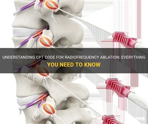 understanding cpt code for radiofrequency ablation everything you need
