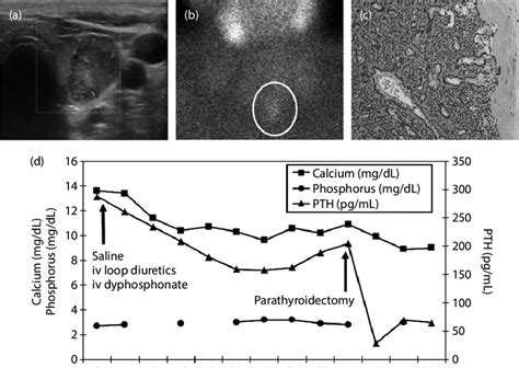 A Neck Ultrasonography Showing A Large Solid Hypoechoic Nodule With Download Scientific