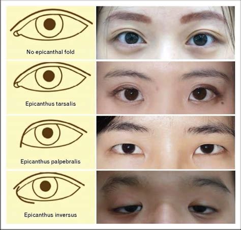 Different Types Of Eyelids at Sean Freddie blog