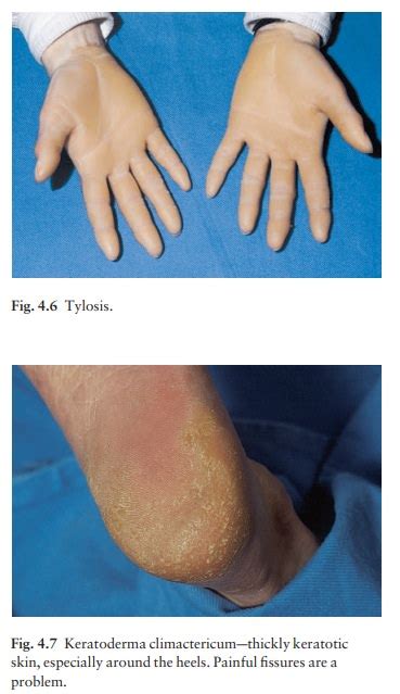 Keratoderma Of The Palms And Soles Keratoderma Of The Palms And Soles