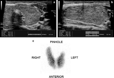 Example Ultrasound And Thyroid Uptake Scan In A 15 Year Old Girl Download Scientific Diagram