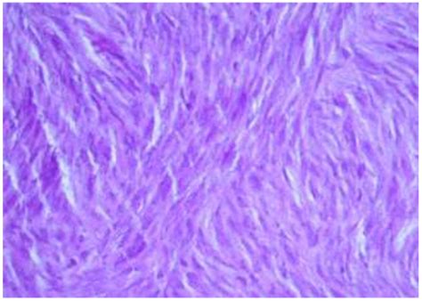 Histology Showing Spindle Cells Of Gist Download Scientific Diagram