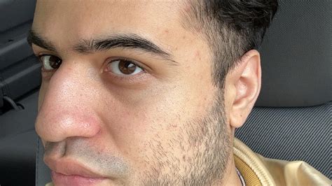 Does This Look Like Sjs R Lamictal