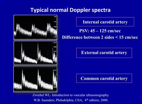 Doppler Ultrasound Of Carotid Arteries Pptx