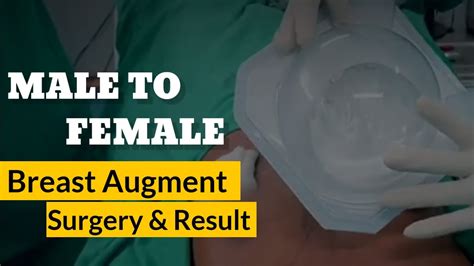 Male To Female Breast Augment Surgery And 21 Days Result Silicon Implant Dr Jayanta Bain