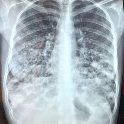 Pdf A Young Woman With Cystic Bronchiectasis Mystery Revealed