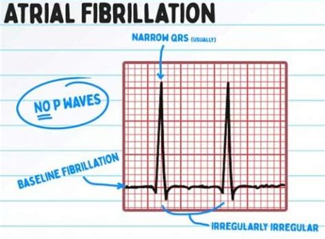 AFIB RVR On EKG Management Of Atrial Fibrillation Health And Willness