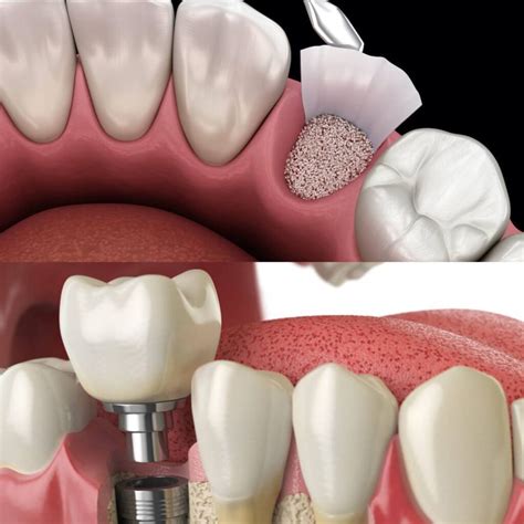 Bone Grafting Vs Dental Implants Key Differences Explained