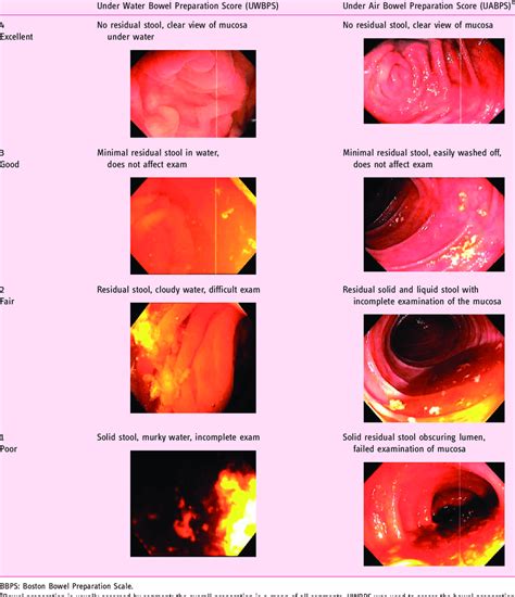 Poor Colonoscopy Prep