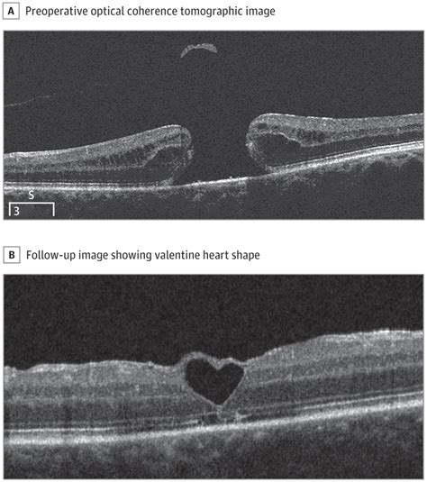 4 Tips For Assessing The Macular Oct Scan Artofit