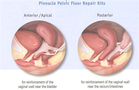 Bladder Prolapse Repair