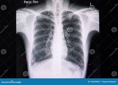 A Chest Xray With Multiple Nodular Infiltrations In The Lungs Stock