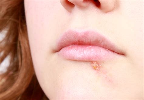 COLD SORES