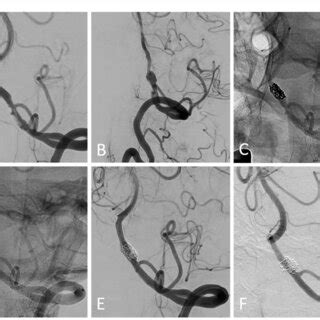 FIGURE E A B Pretreatment Digital Subtraction Angiography DSA From Download Scientific