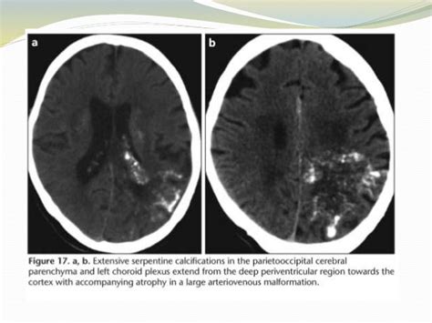 Physiological And Pathological Calcification Of Brain