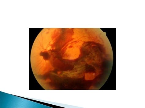 Approach To Monocular Blindness