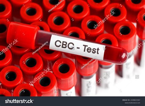 Cbc Test Abnormalities Red Blood Cells Stock Photo 2199837267 Shutterstock