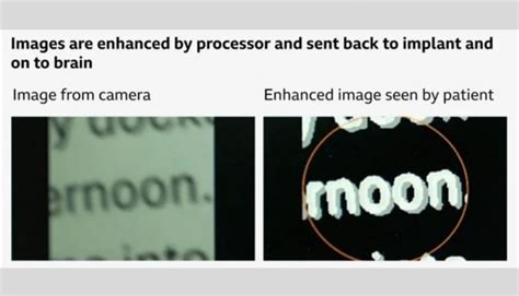 Blindness Cured With Revolutionary ‘eye Implants By Medical Experts