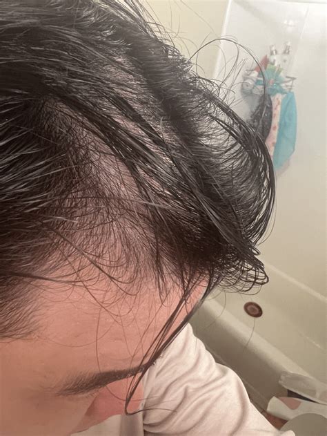 [6 Month Diffuse Thinner Update] 23yo Korean R Tressless