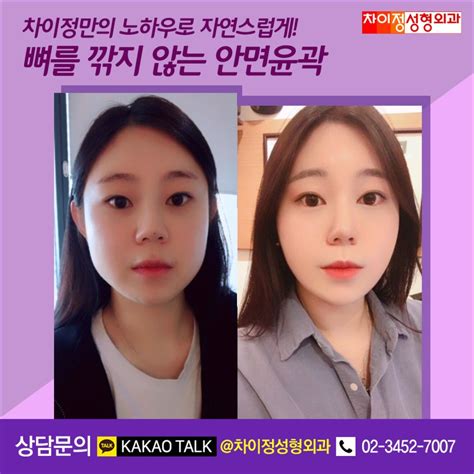 차이정성형외과 차이정만이 노하우로 자연스럽게 예뻐지기 뼈를 깎지 않는 안면윤곽 안면윤곽 교근축소술 저온교근축소술 교근축소술은 기본적으로 전기를 이용하여 열을