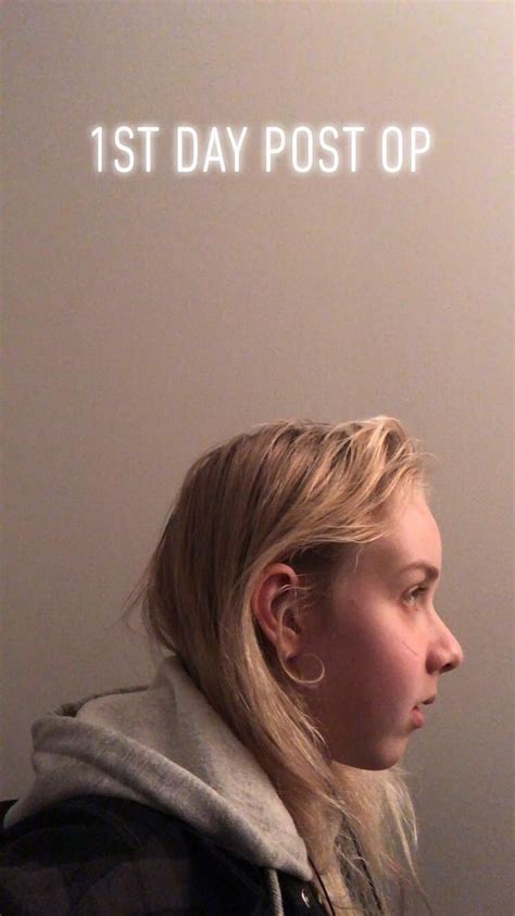 Related To My Last Post Before And After Sarpe Surgery Rjawsurgery