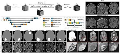 Ai Model Can Generate 3d Brain Mri Images While Addressing Data Scarcity And Privacy Concerns