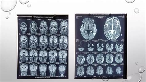 Encephalitis Mri Discussionpptx