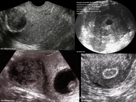 PPT FIBROME UTERIN PowerPoint Presentation Free Download ID