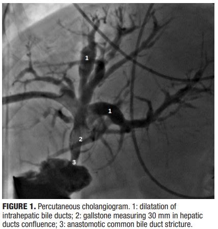 Percutaneous Cholangioscopy And Laser Biliary Lithotripsy For Biliary