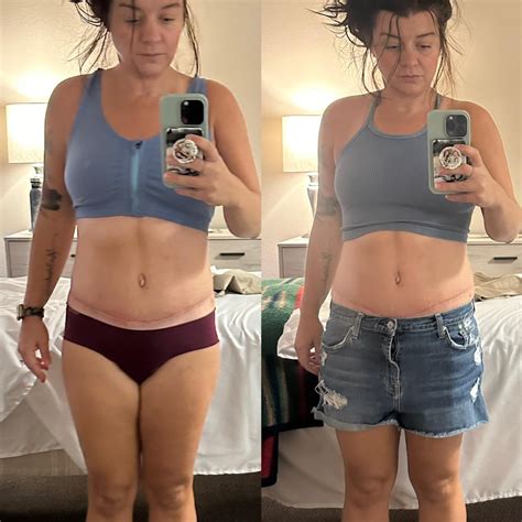 Swelling Upper Abs R Tummytucksurgery
