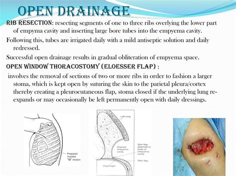 Ppt Empyema Powerpoint Presentation Free Download Id 5650888