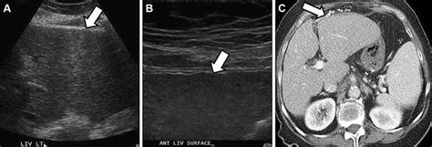 Liver Surface Nodularity In Cirrhosis High Resolution Ultrasound May