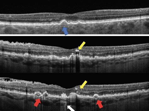Oct An Indispensable Tool In Retina Care