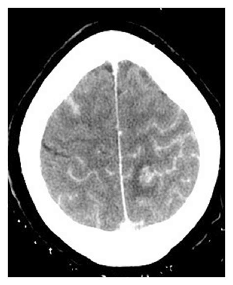 Initial Cranial Ct Demonstrated Convexity Subarachnoid Hemorrhage And A Download Scientific