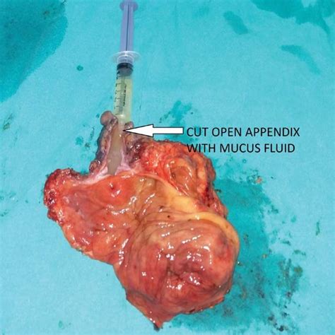 Resected Specimen Showing Cut Open Appendix With Mucous Fluid Content