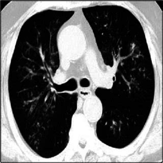 Initial Chest CT Scan Reveals Micronodules And Tree In Bud Appearance Download Scientific