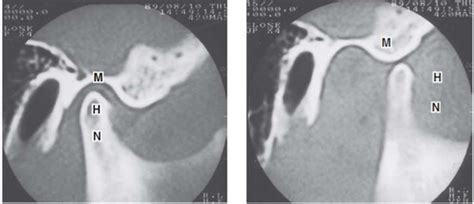 Temporal And Infratemporal Regions Flashcards Quizlet
