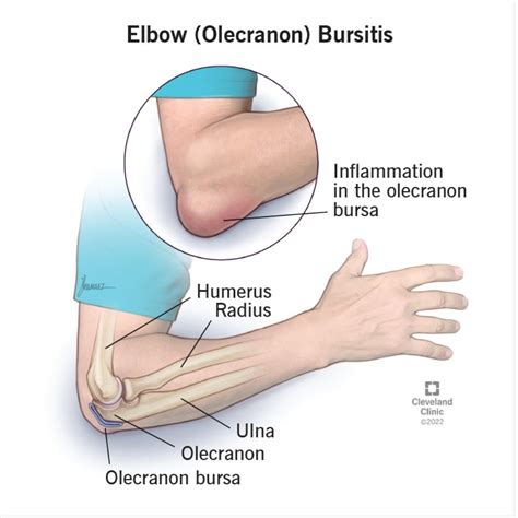 Physical Therapy For Elbow Bursitis Mangiarelli Rehabilitation