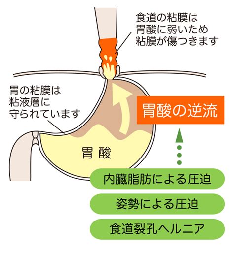 胃酸逆流の症状と原因