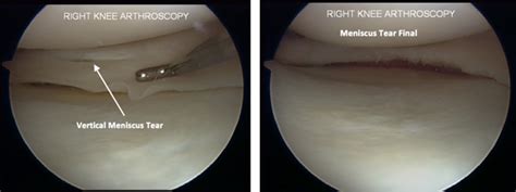 Meniscus Tear DOCJOINTS DR SUJIT JOS Total Joint Replacements With The Best Quality Care At